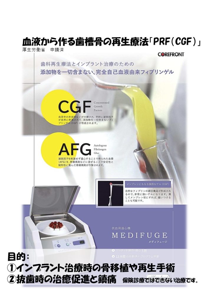 血液から作る歯槽骨の再生療法「PRF（CGF）」 - 新潟市中央区 | インプラントと親知らず抜歯のかつみ歯科口腔外科